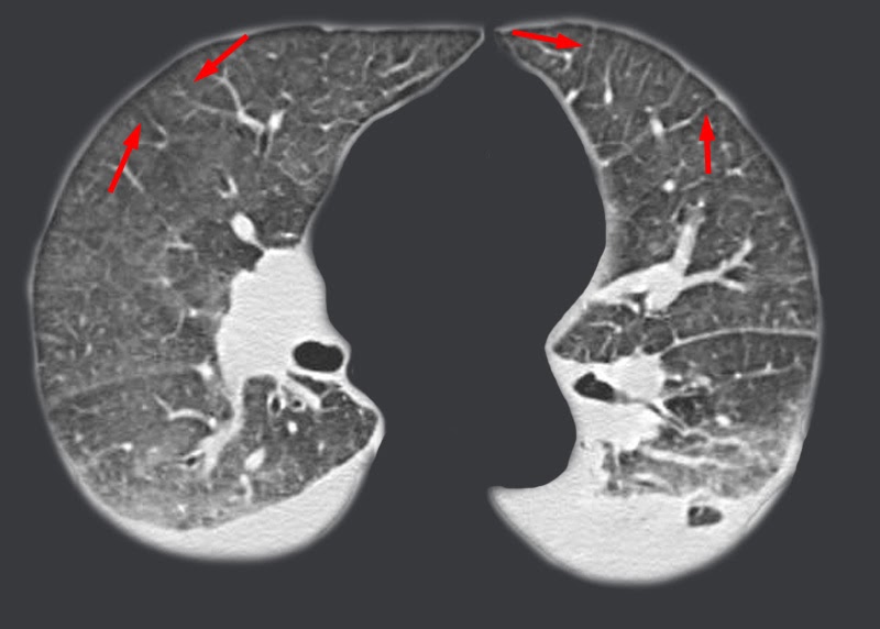 RadiologySpirit: Interlobular Septal Thickening