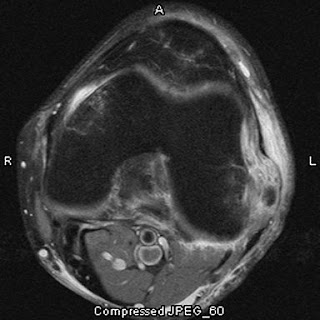 RadiologySpirit: Lateral Collateral Ligament Tear