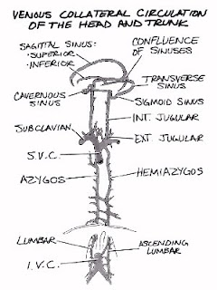 RadiologySpirit: Superior Vena Cava Syndrome