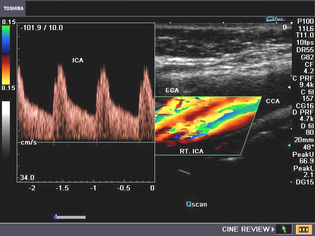 RadiologySpirit: Spectral Doppler waveforms of the normal ICA (internal ...