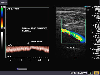 RadiologySpirit: Normal phasic changes in venous flow during respiration: