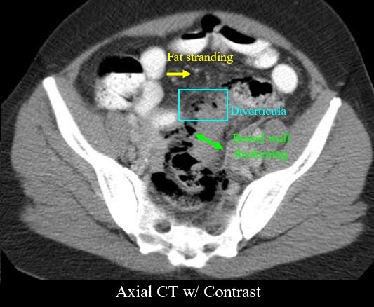RadiologySpirit: Diverticulitis of the Sigmoid Colon with Fat Stranding ...