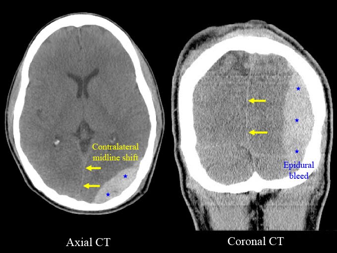 RadiologySpirit: Epidural Hemorrhage