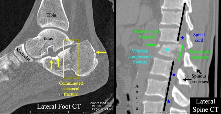 RadiologySpirit: Lover's Fracture
