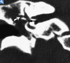 RadiologySpirit: Labyrinth fistula