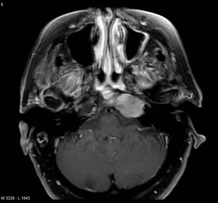 RadiologySpirit: cholesterol granuloma