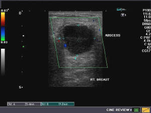 RadiologySpirit: breast abscess