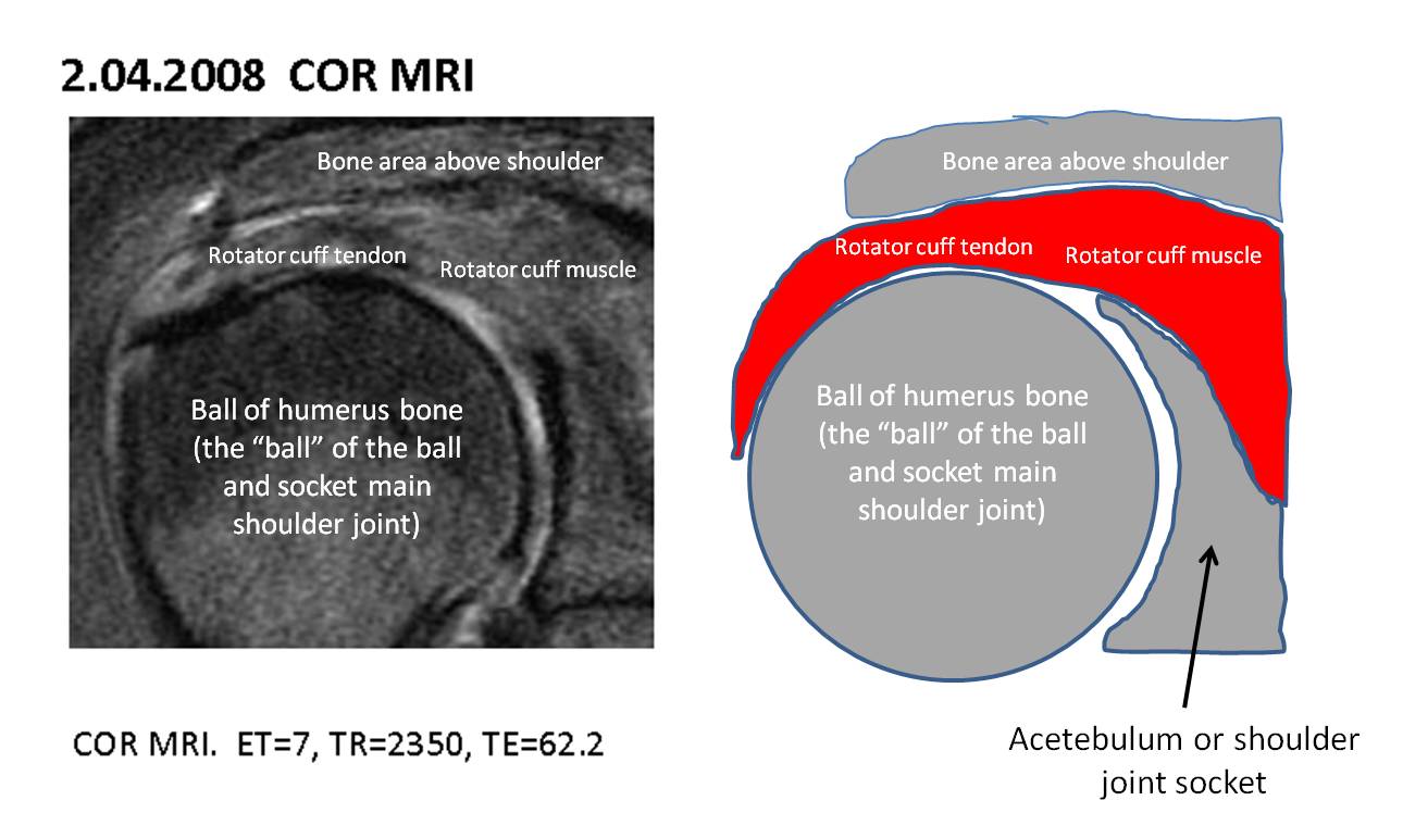 RadiologySpirit: supra-spinatous tendon(anatomy)