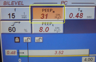 FREMITUS: What is p-High?