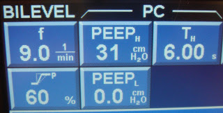 FREMITUS: What is t-High?: APRV terminology