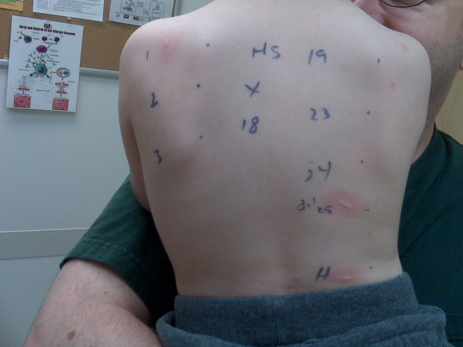Life with Alexander: Allergy Test Results