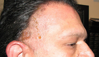 Dangerous Hair Dye: May 28,2009 hair dye allergy reaction