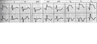 Cardiología - IAM C / ST ELEVADO: SINDROME CORONARIO AGUDO - Infarto ...
