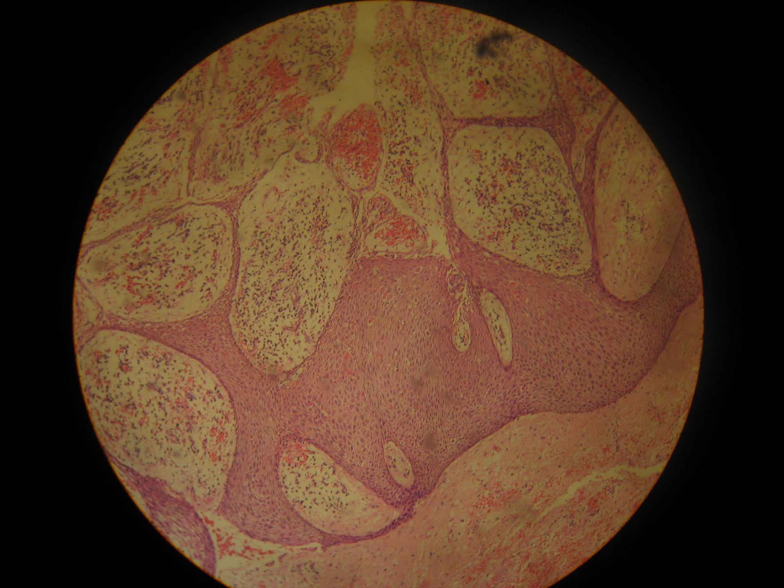 Dentistry and Medicine: Radicular cyst