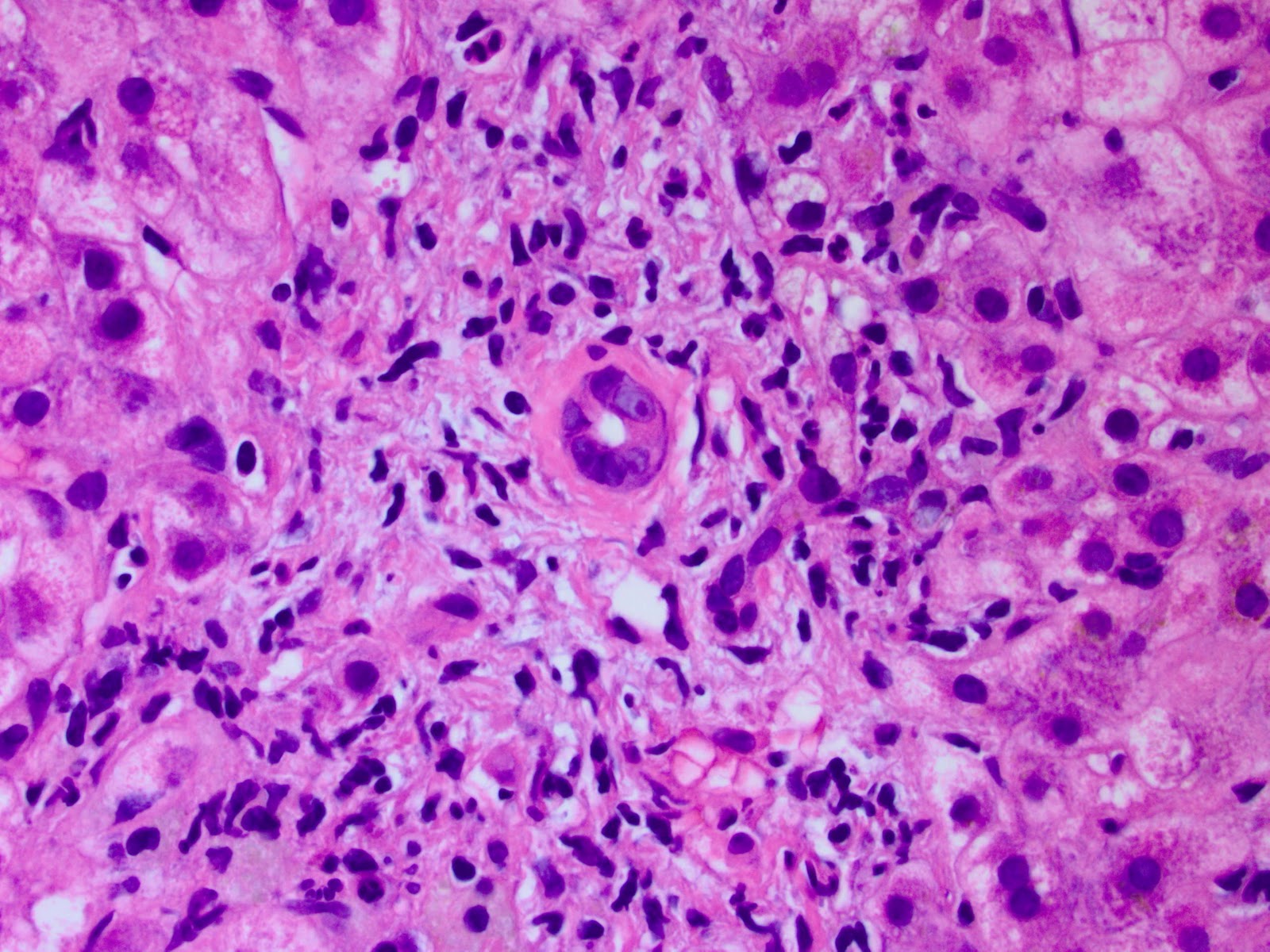 Liver and Kidney Transplant Pathology: Early Chronic Rejection in a ...