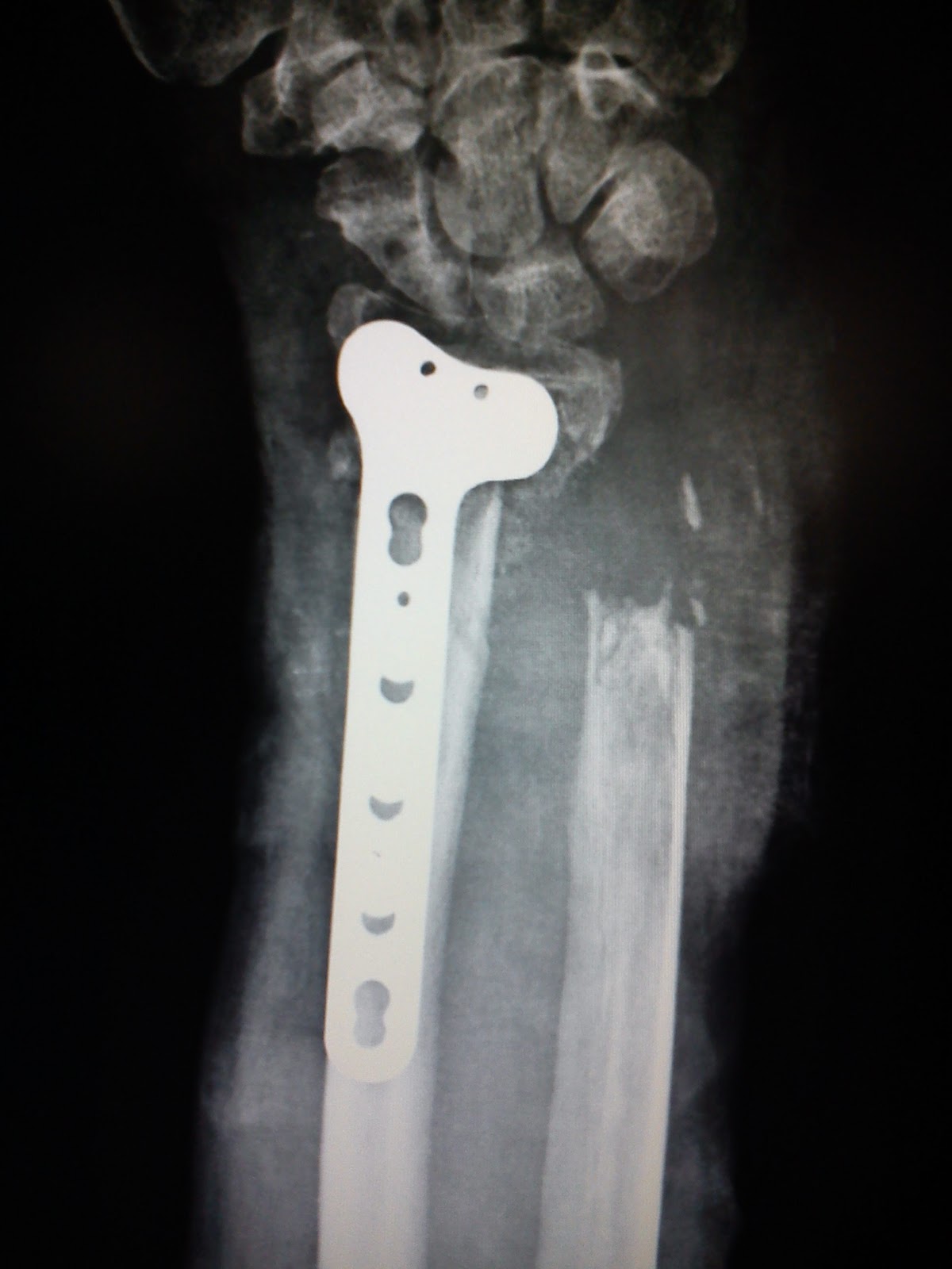orthopaedics update: Darrach's Procedure ,locking volar plate , bone graft