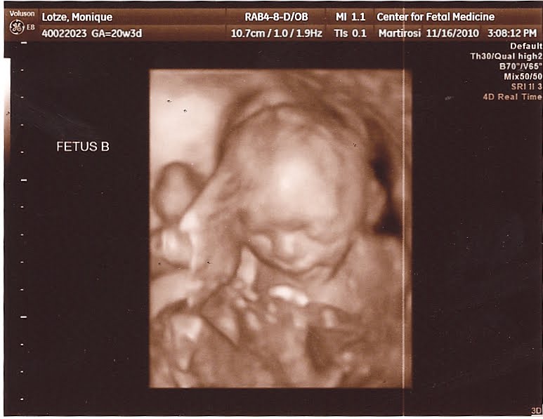 TheLotzeFamily 20 Weeks 3 Days thelotzefamily-20-weeks-3-days