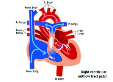 Excellent Adventures of Trevor, Kara and Allison: Trevor's Heart ...