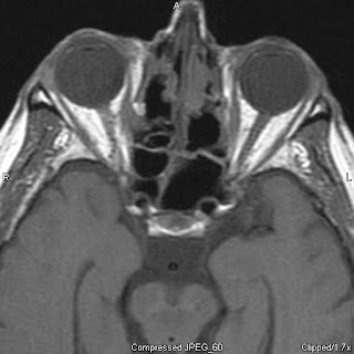 mri procedures and pathology: ORBIT PATHOLOGY