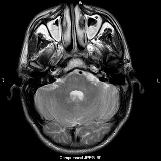mri procedures and pathology: sinuses and facial bones
