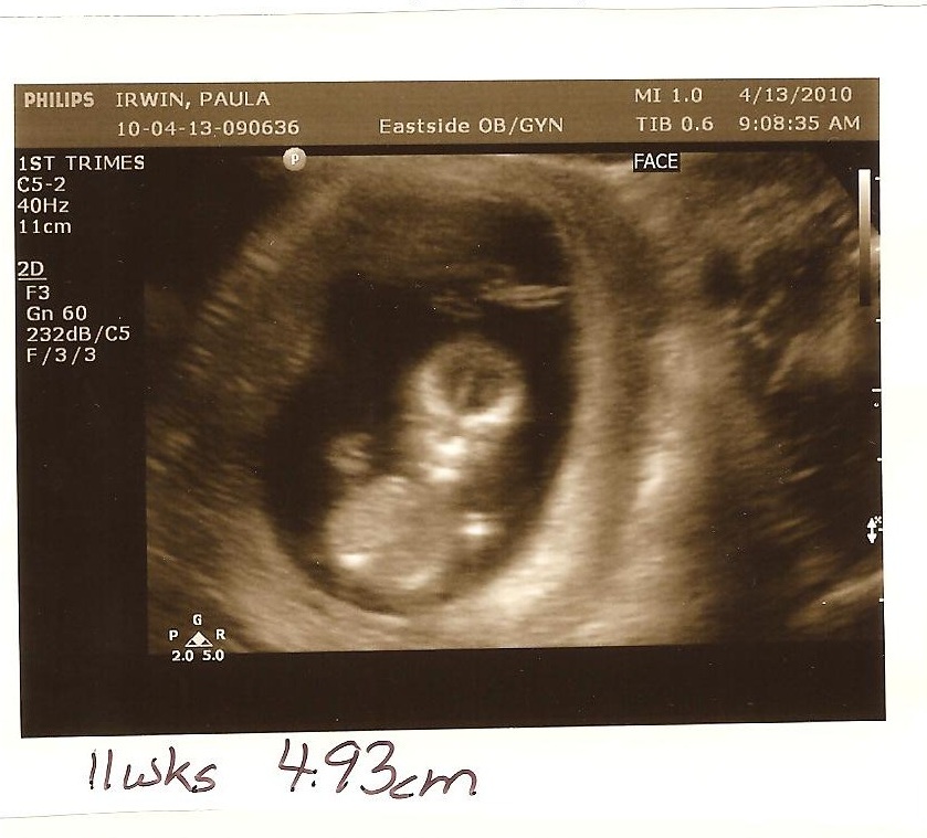Irwin with an "I": 11 Week Ultrasound