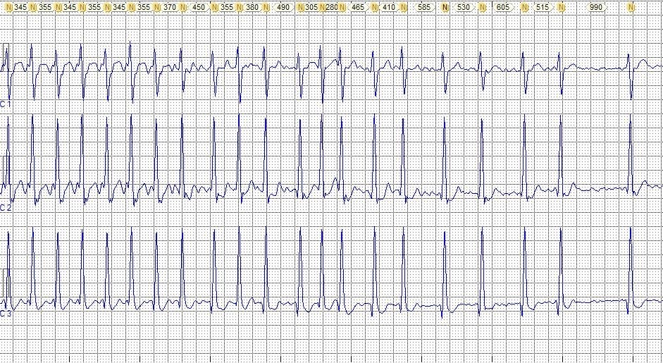 Atlas de Holter: FLUTTER ATRIAL