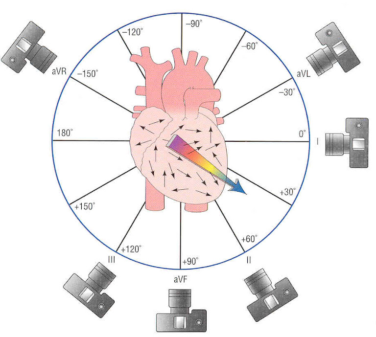 Atlas de Holter: BIGEMINISMO VENTRICULAR