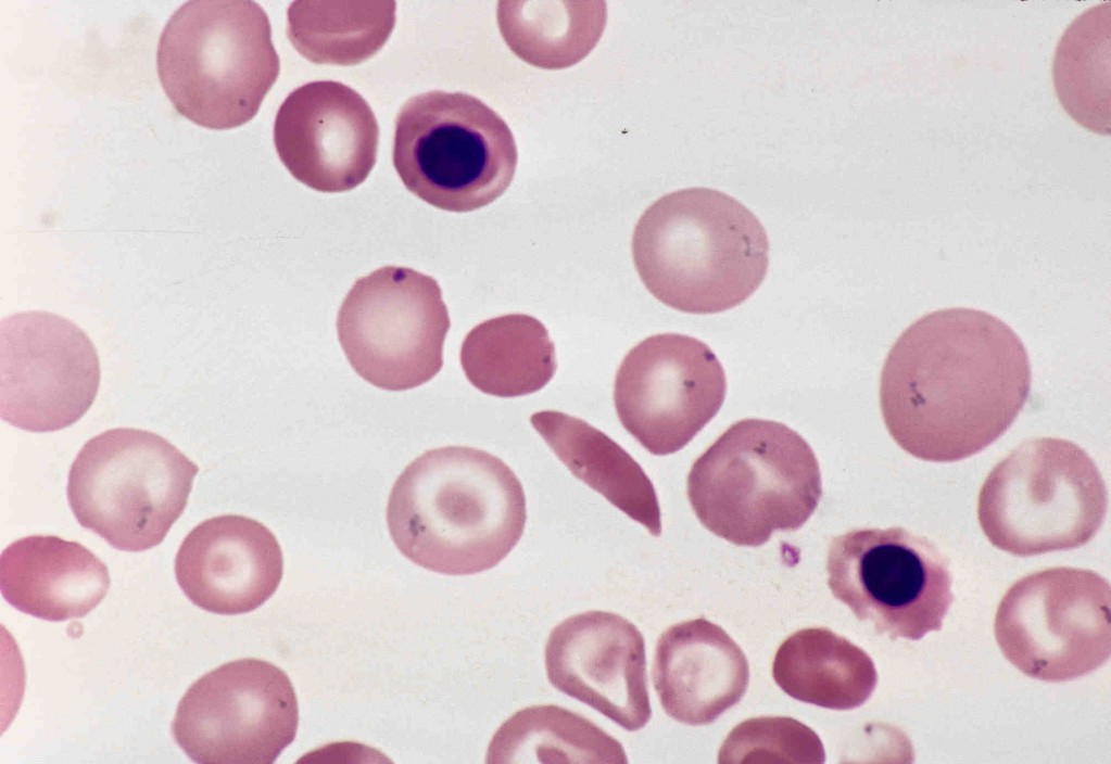 Nephrology World: The kidney in sickle cell disease