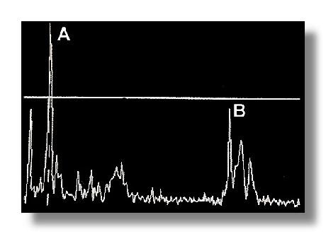 SonoZone: Ultrasound Modes: A, B, & M