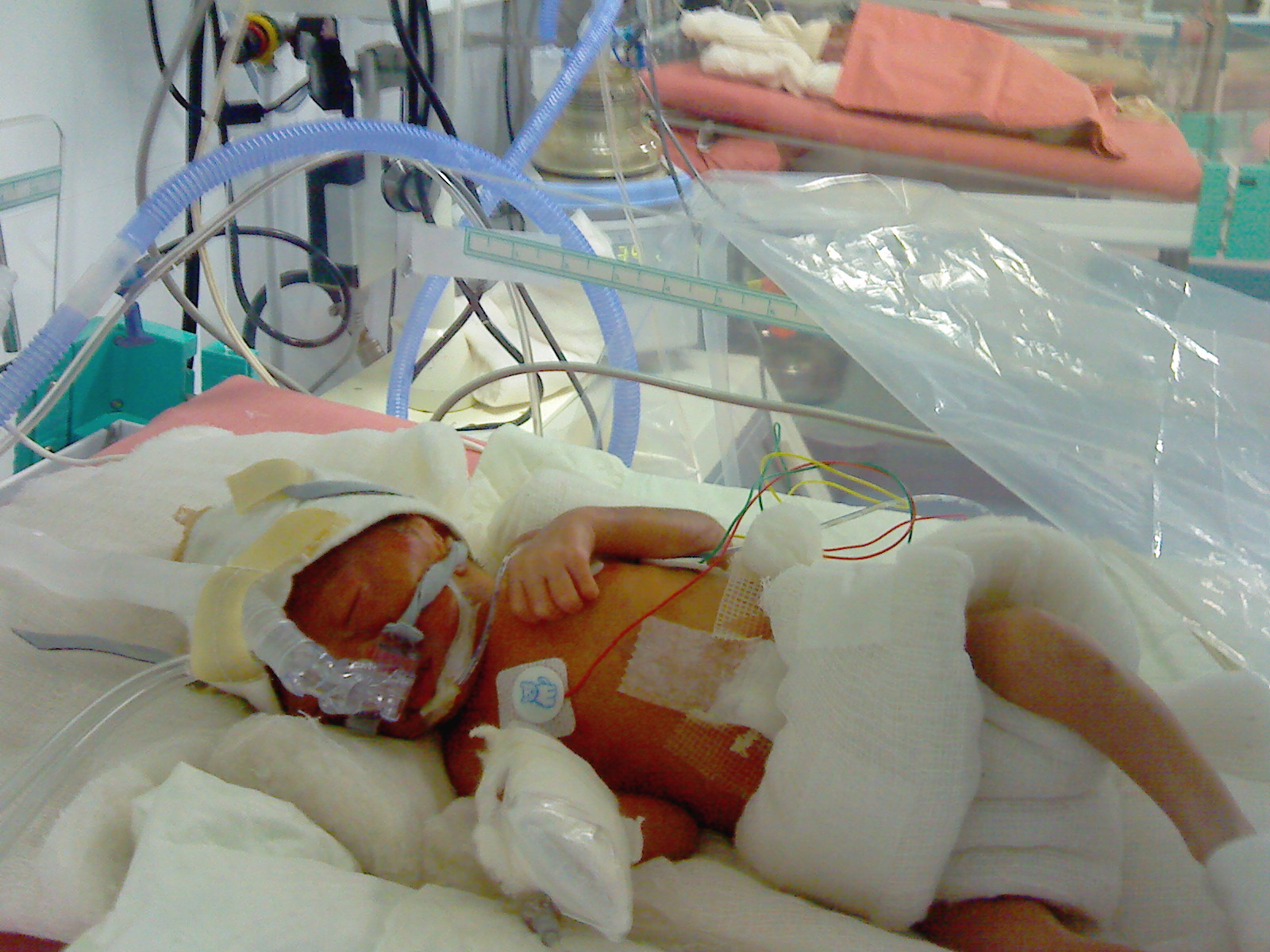 NEW HORIZONS: Babbu's Photo in NICU at BREACH CANDY HOSPITAL