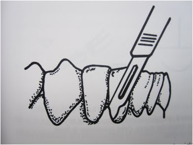 TERAPIA DE ACCESO Y VISIBILIDAD CX PERIODONTAL: DEFINICIÓN GENERAL