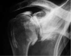 "Miss Capsulite": La CAPSULITE RETRACTILE, c'est quoi