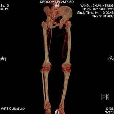 Days of a vascular surgeon in Taiwan: case: FP bypass using Distaflo graft