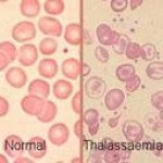 HEMOGLOBINOPATÍAS: TALASEMIA