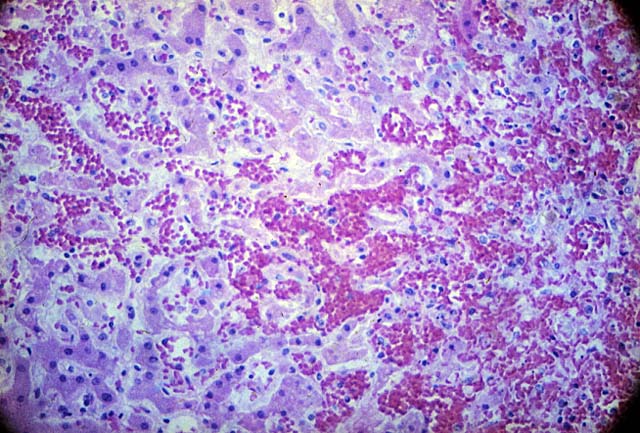 Seguindo a Patologia: HIPEREMIA