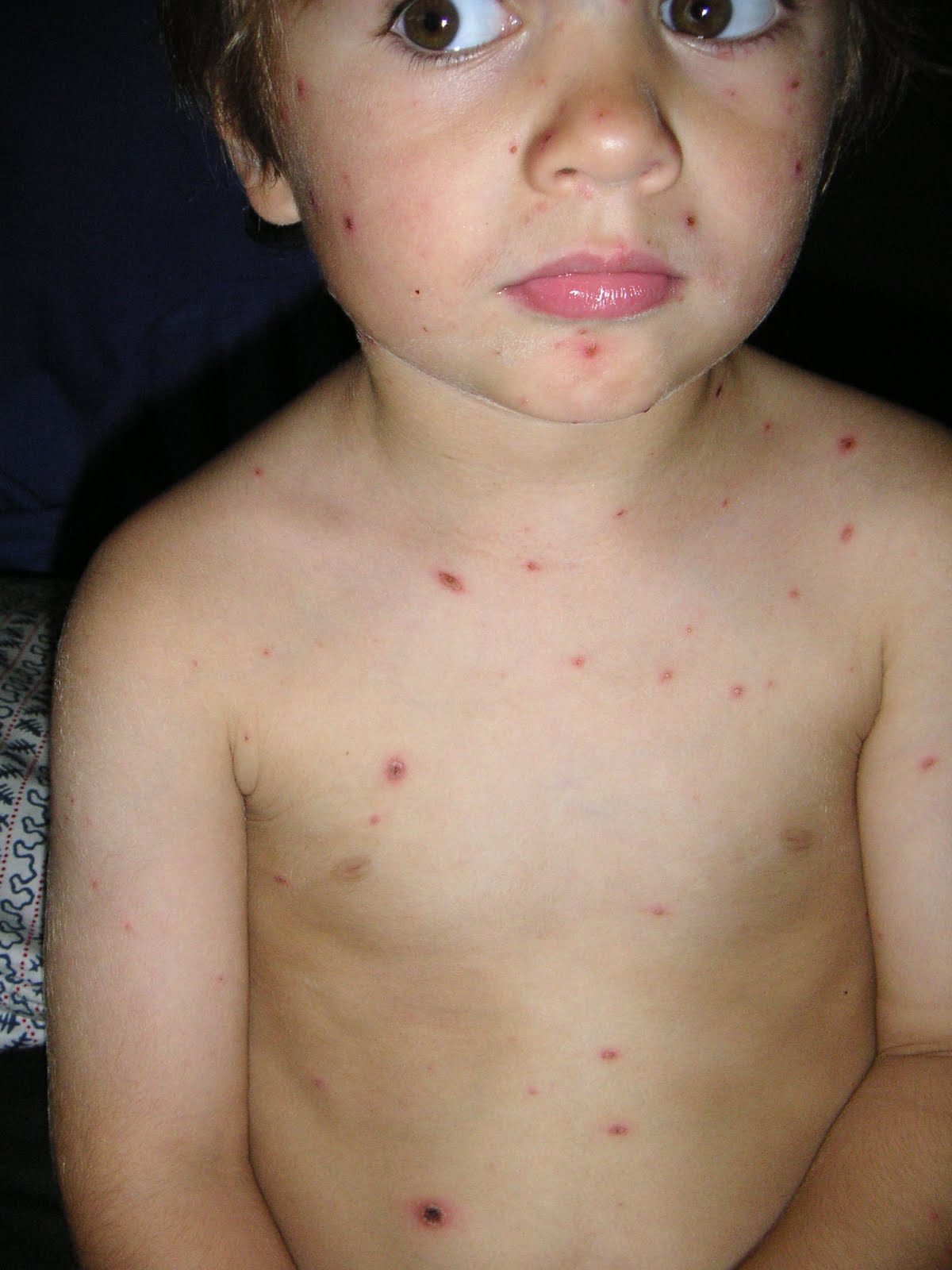 Varicelle; chicken pox; varicella