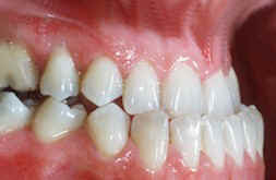 Surrey Invisalign: What is CrossBite?