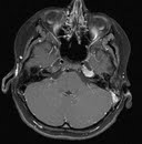 Rhoda's CT/MRI Procedures: Mastoiditis