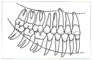 Cellulites péri-maxillaires d'origine dentaire