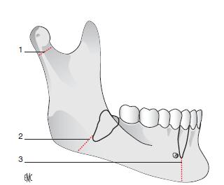 Les fractures mandibulaires