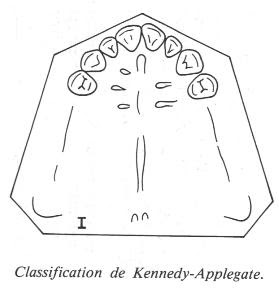 Classification des édentements . ~ [ Club Dentaire ]