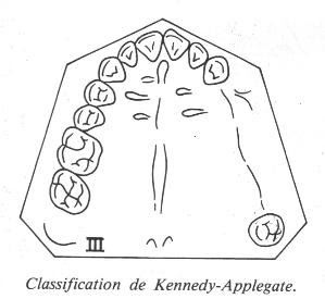 Classification des édentements
