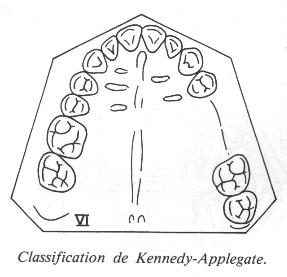 Classification des édentements