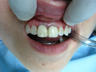 My ♥ Dentistry ☆: PFM Crown change to Full Cramic Crown