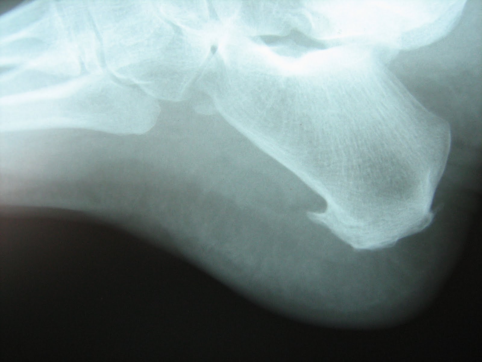 ESPOLON CALCANEO Y FASCITIS