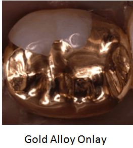 Dental Restorations