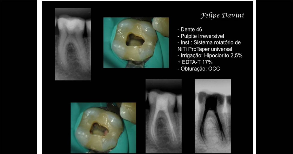 Acesso Endodontico Molar Inferior - RETOEDU