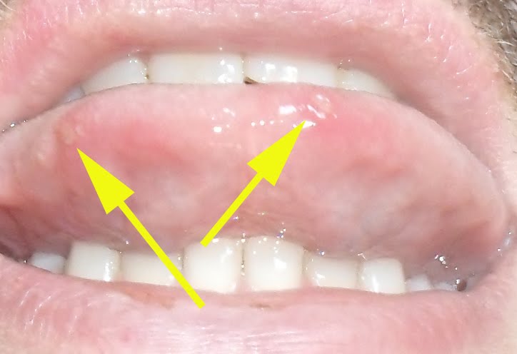 Valigetta trucco: Perchè mi vengono le afte in bocca