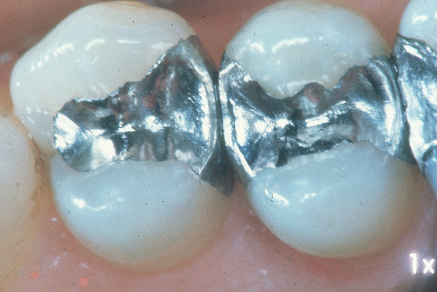 Odonto Net: Amálgama, e sua aplicabilidade na Odontologia