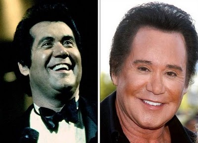 Wayne Newton Before And After | Face Lift Pictures